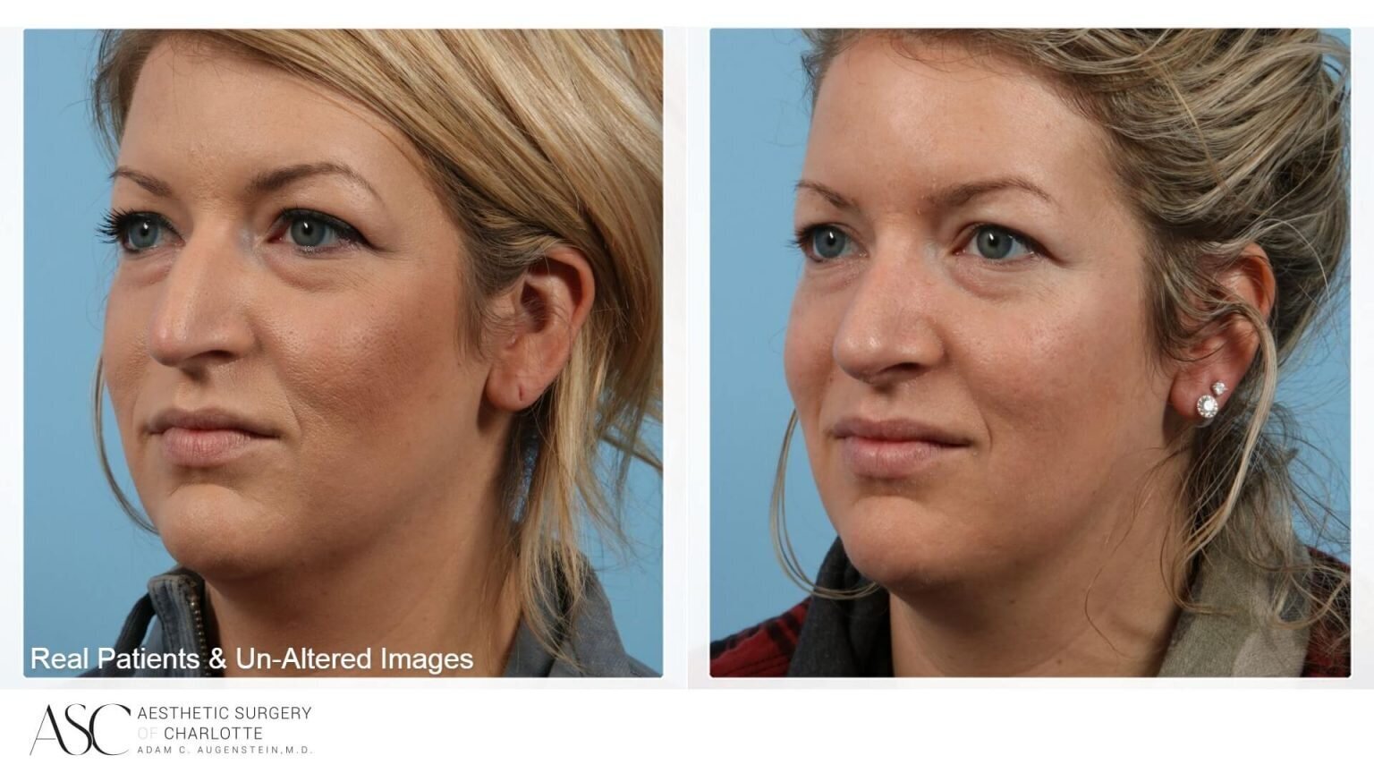 Facial Plastic Surgery Charlotte | Aesthetic Surgery of Charlotte